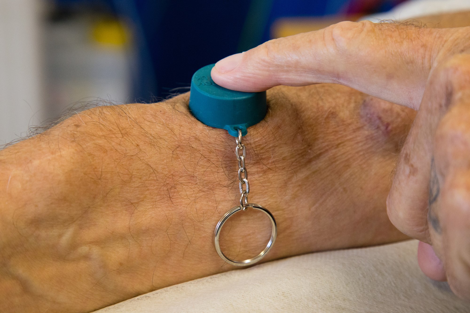 Haemodialysis access with an arteriovenous fistula | Kidney Care UK