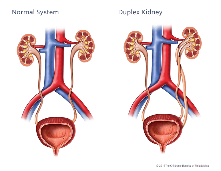 Duplex kidneys | infoKID