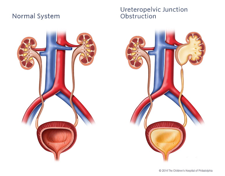 Pelvi-ureteric junction (PUJ) dysfunction and obstruction | infoKID