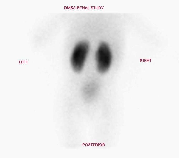 DMSA scan | infoKID
