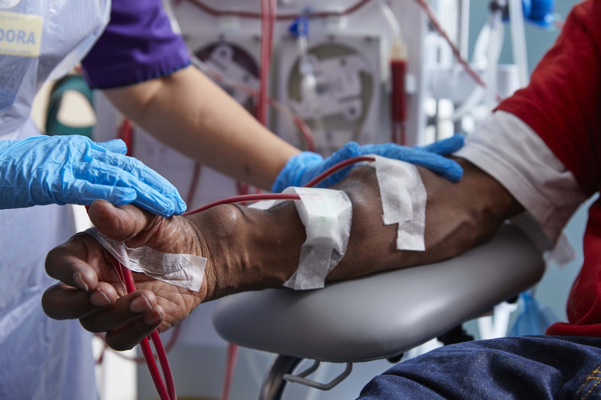 Haemodialysis access with an arteriovenous fistula | Kidney Care UK