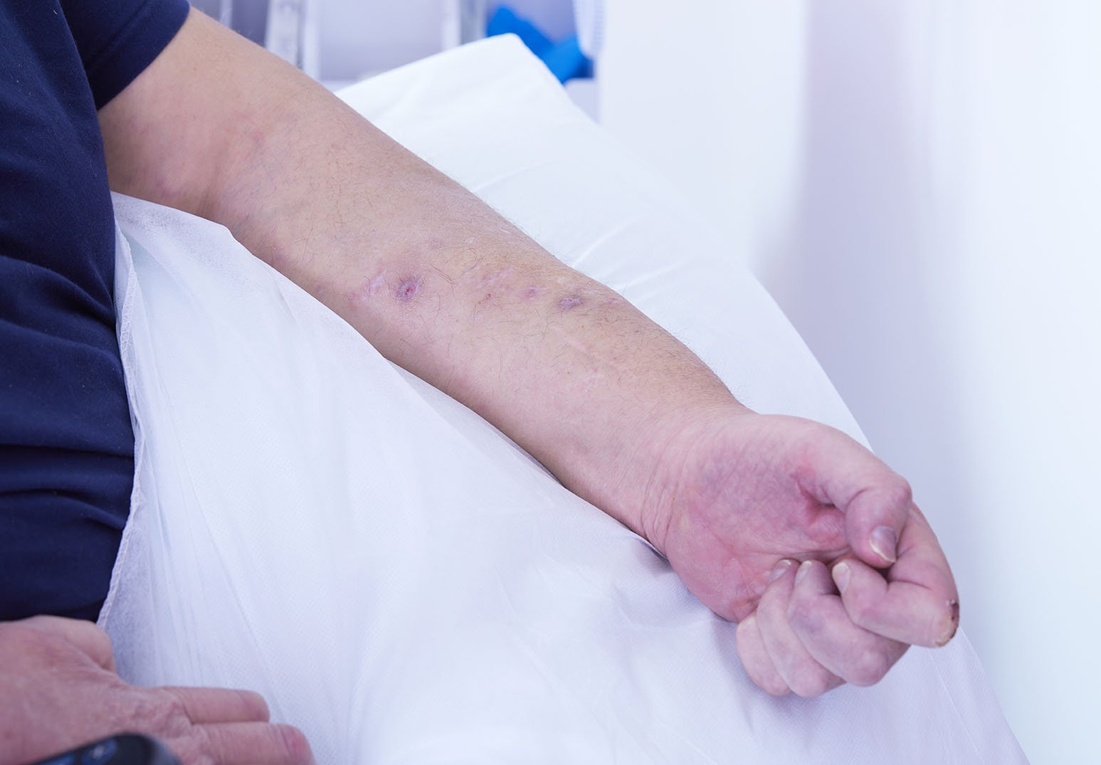 How to check your fistula and advice on needling | Kidney Care UK