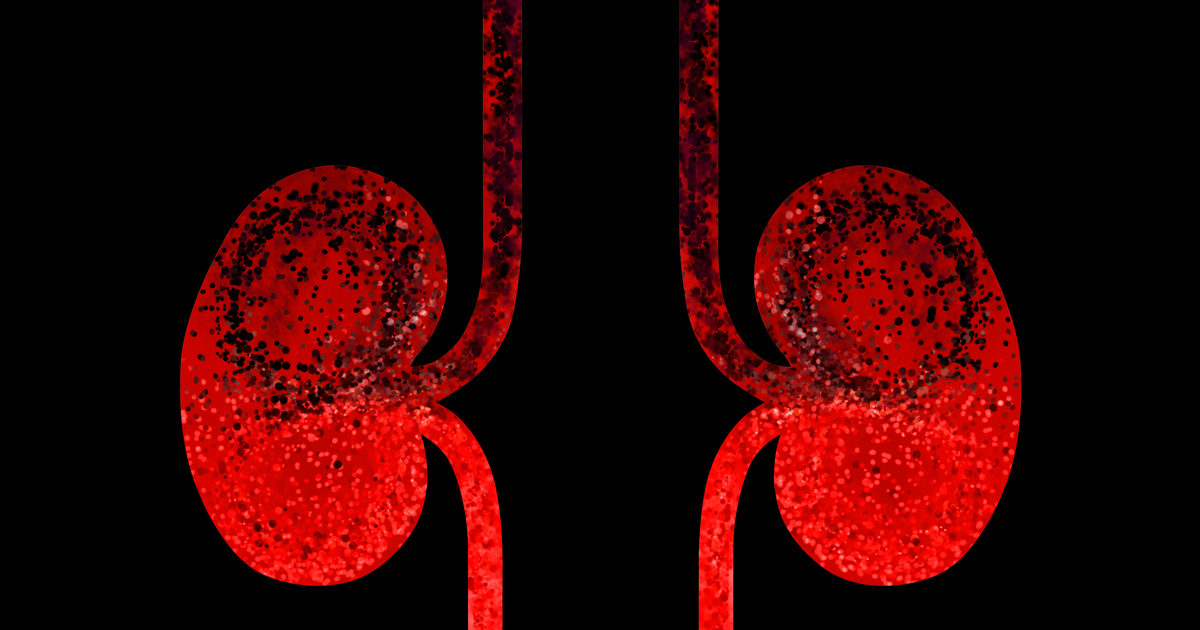 One in four people unaware of the main signs of chronic kidney disease ...